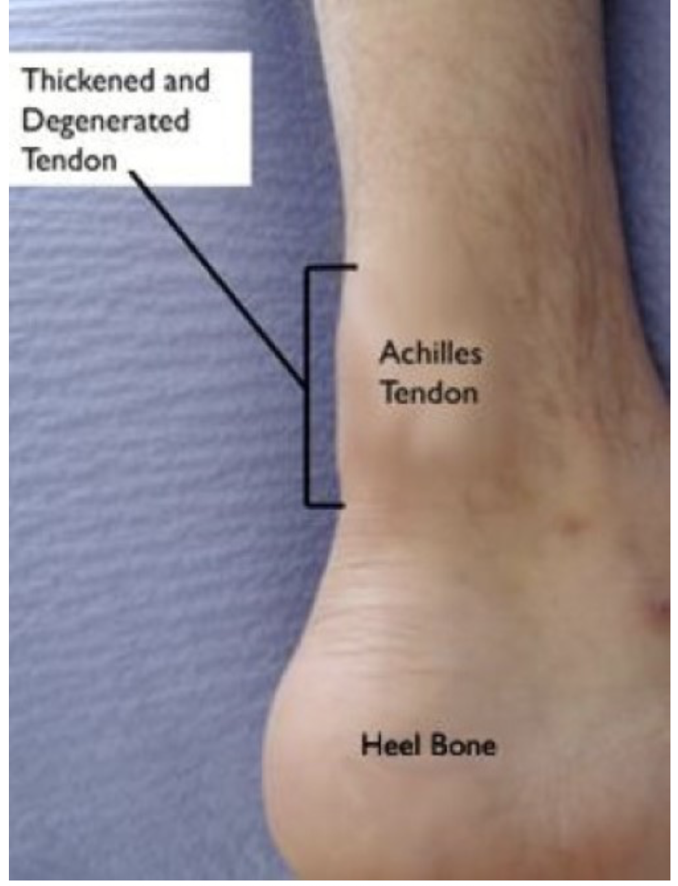 Τενοντίτιδα Αχιλλείου τένοντα - ΟΡΘΟΠΕΔΙΚΟΣ ΧΕΙΡΟΥΡΓΟΣ