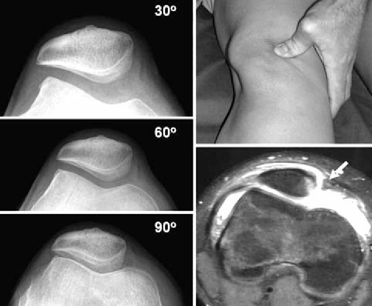 Επιγονατιδομηριαίος Πόνος - ΟΡΘΟΠΕΔΙΚΟΣ ΧΕΙΡΟΥΡΓΟΣ