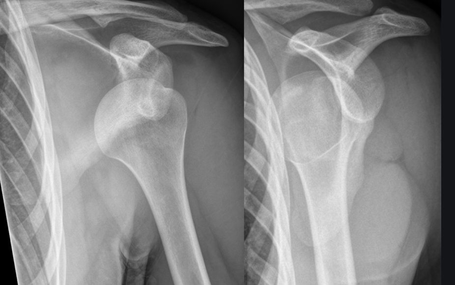 Διάγνωση και θεραπεία εξαρθρήματος ώμου - ΟΡΘΟΠΕΔΙΚΟΣ ΧΕΙΡΟΥΡΓΟΣ